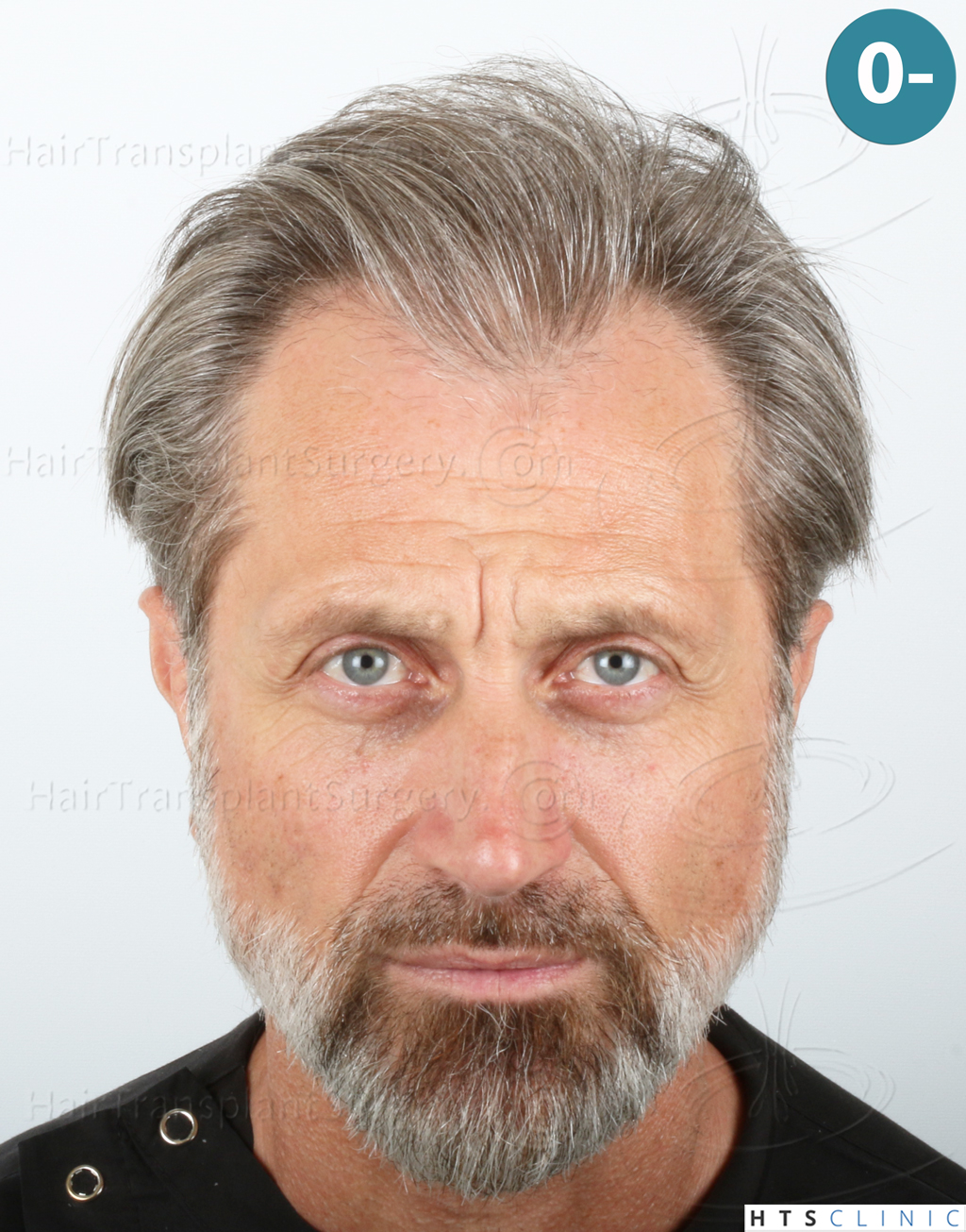 Dr Jean Devroye Hts Clinic 2252 Fue Hairline Restoration Hair